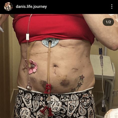 Danis Recent Update Tw Bruising Rillnessfakers