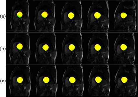 Figure 2 From Left And Right Ventricular Segmentation Based On 3d