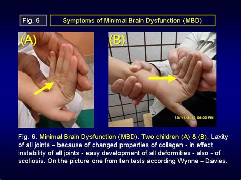 Minimal Brain Dysfunctions Mbd Causes Clinical Symptoms Deformity Of The Feet Knees Hips
