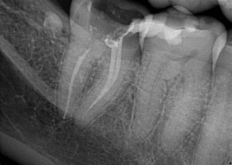 Root Canal Tooth Infected Retreat Or Extract Raskdentists