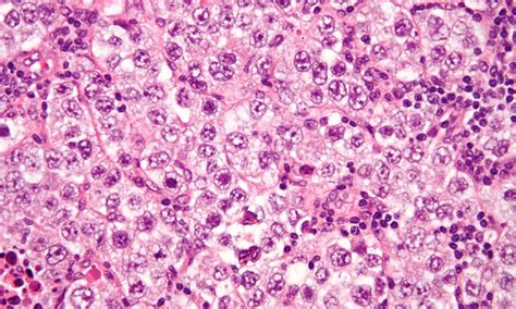 Etiologic Factors In Testicular Germ Cell Tumors