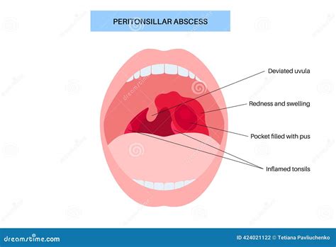 Peritonsillar Abscess Poster Vector Illustration