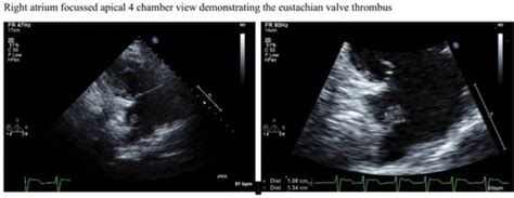 Eustachian Valve Echo