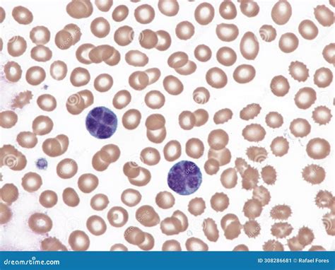 Anaplastic Large Cell Lymphoma Peripheral Blood Stock Image Image