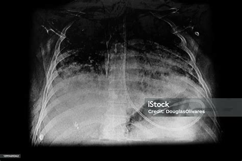 Chest X Ray Showing Nasogastric Tube Dobhoff For Feeding Stok Fotoğraflar And X ışını Görüntüsü