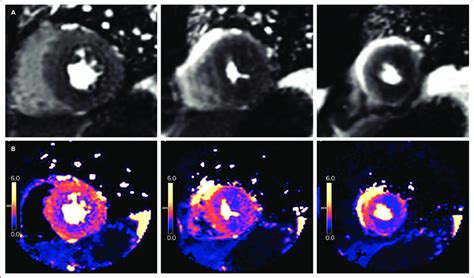 Role Of Cardiac Magnetic Resonance In Assessing Microvascular Disfunction Download Scientific