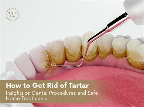 Dental Tartar Removal Techniques And Tools Explained