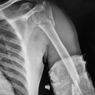 A Fracture In The Proximal Part Of The Humerus And Another Fracture In Download Scientific