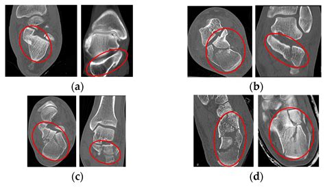 Sanders Classification Of Calcaneal Fractures At Jean Partain Blog