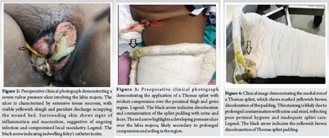 Vulvar Pressure Ulcer An Inadvertent Complication Of Thomas Splint