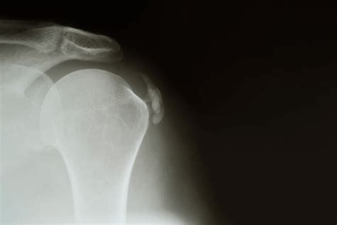 Shoulder Calcification