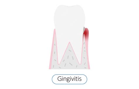Illustratie Per Stadium Van Parodontitis Gingivitis Premium Vector