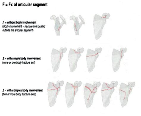 Scapula Fracture Classification Ao At Booker Zuniga Blog Scapula Fracture Classification Ao At Booker Zuniga Blog