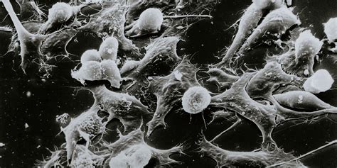 Haemangioblastoma Brainbook