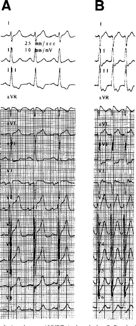 Figure 1 From A New Electrocardiographic Algorithm Using Retrograde P Waves For Differentiating