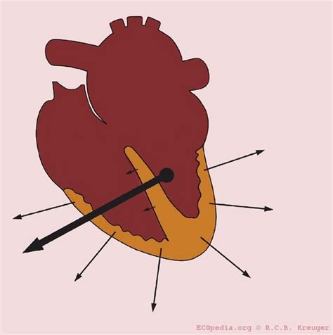 Right Axis Deviation Wikidoc