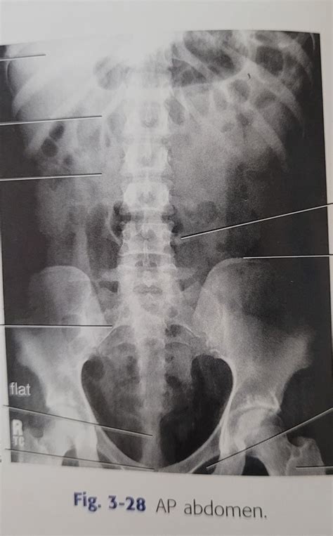 Ap Abdomen Radiograph Diagram Quizlet