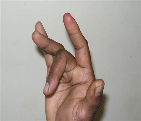 How To Straighten My Middle Finger At Joseph Graves Blog