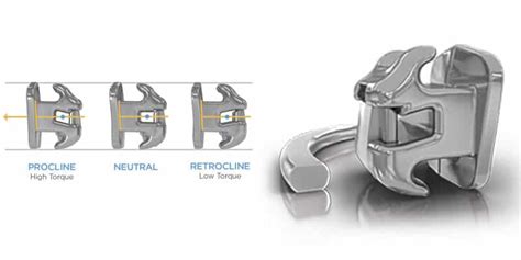 Damon Ultima System — A Reengineered Passive Self Ligation Brace System
