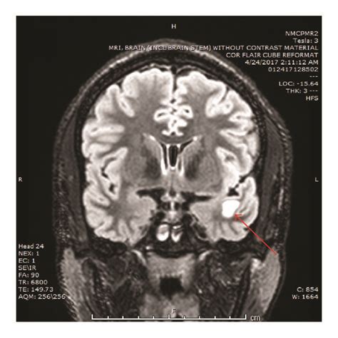 Brain Mri Demonstrating Left Temporal Lobe Lesion A C Axial And