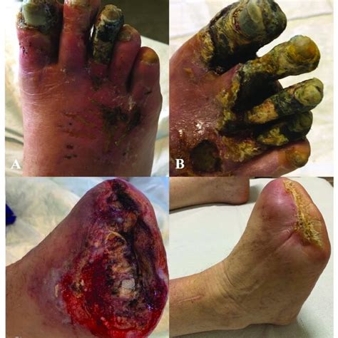 Ab Extensive Forefoot Gangrene C Open Trans Metatarsal Amputation