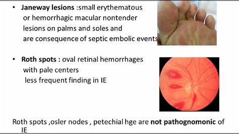 Janeway Lesions Pathophysiology
