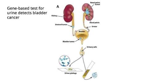Uroseek Enables Noninvasive Detection Of Bladder Cancer Technology Networks