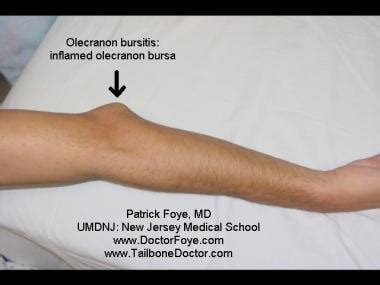 Olecranon Bursitis Practice Essentials Etiology Prognosis