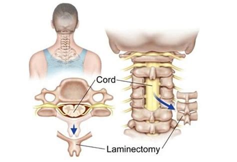 Laminotomy Vs Laminectomy Which One To Choose