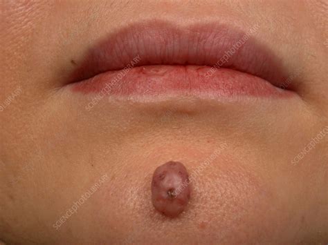 Intradermal Nevus