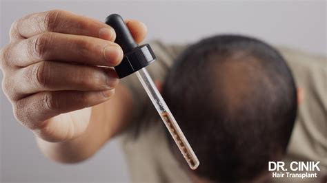 Minoxidil Pour Le Traitement De Lalopécie Androgénétique Efficacité