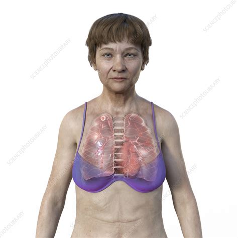 Woman With Apical Tuberculosis Illustration Stock Image F0419203