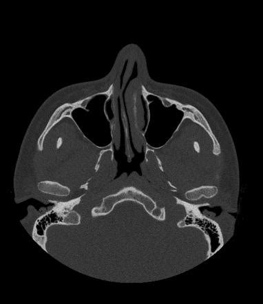 Face Bone Anatomy Ct