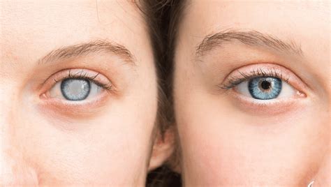 Do Eyes Glaze Over When You Die At William Ashbolt Blog