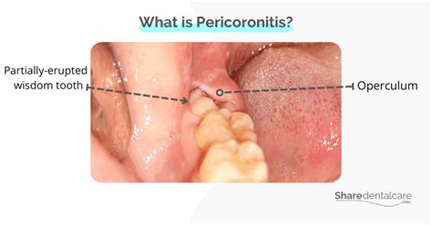 Pericoronitis Smell Causes Of Bad Breath And Treatments Share Dental Care