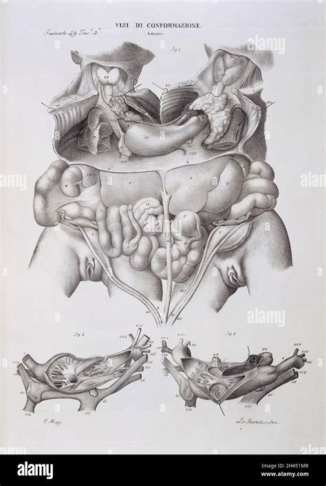 Abnormalities Of The Formation Of The Foetus Conjoined Twins Stock
