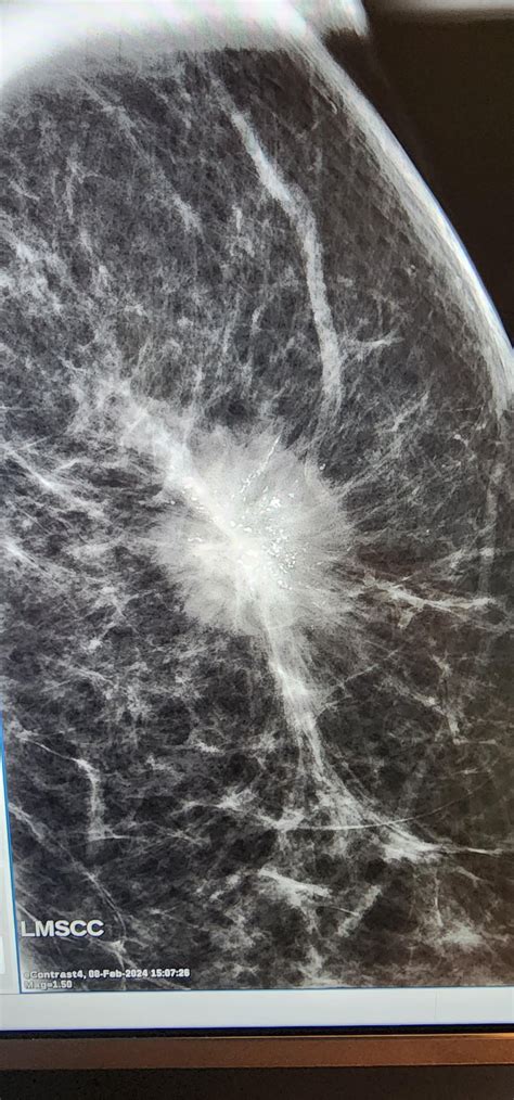 Friendly Reminder Dont Wait For Your Mammogram Rradiology