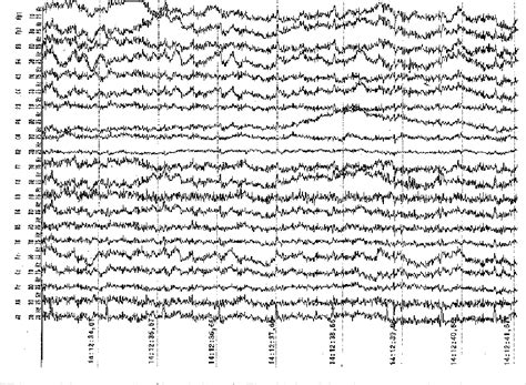 Figure 15 From Brain Tumor Classification Based On Eeg Hidden Dynamics Semantic Scholar