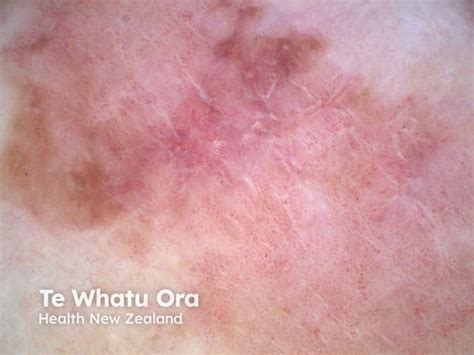 Hypomelanotic Superficial Spreading Melanoma Polarised Dermoscopy View