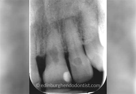 Endodontic Case Studies Edinburgh Endodontist