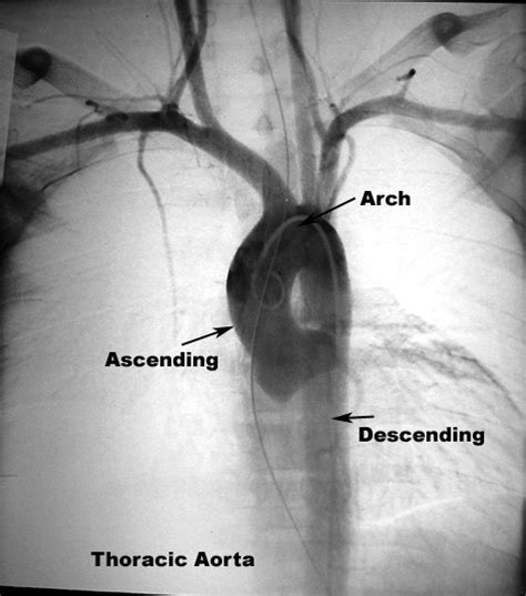 Angiogram