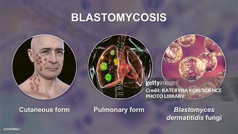 Chronic Pulmonary Blastomycosis Actnci
