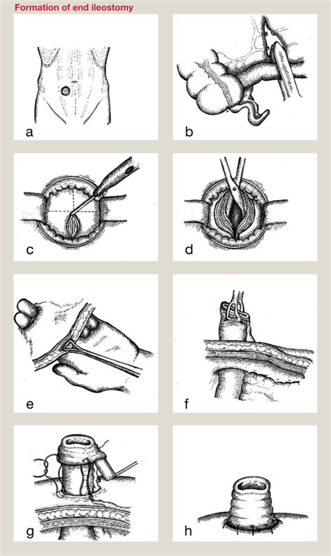 Intestinal Stomas Surgery Oxford International Edition