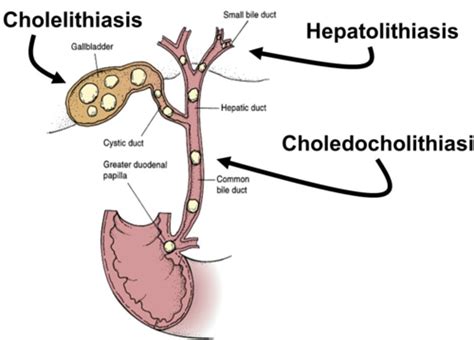 Clinical Vignettes Biliary Tract Disorders Flashcards Quizlet