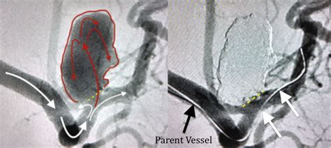 Aneurysm Treatment Options Clipping Vs Coiling Explained
