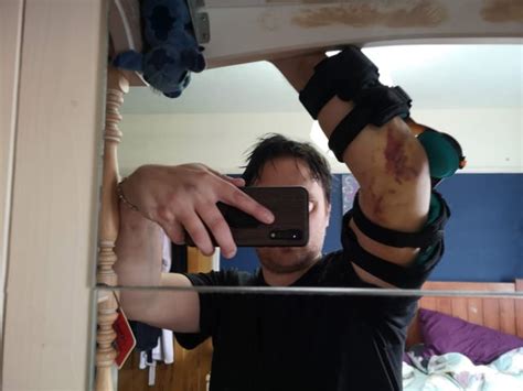 Dislocated My Elbow Rmakemesuffer
