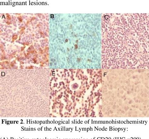 Figure 2 From Diffuse Variant Of Nodular Lymphocyte Predominant Hodgkin