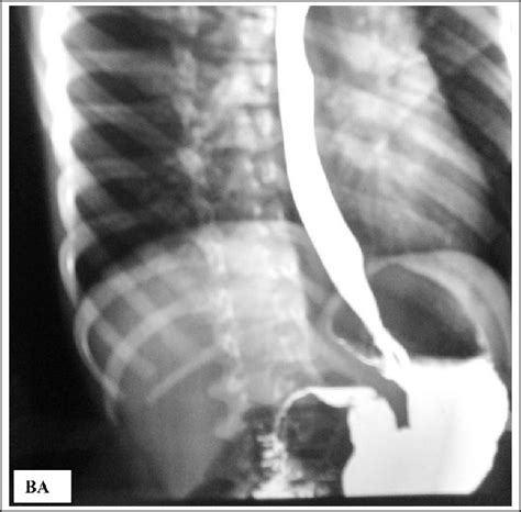 Pre Dilatation Barium Swallow Dilated Esophagus Fig2 Post