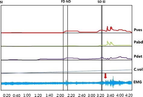 A A Preoperative Uds Showed A Functional Bladder Capacity Of 95 Ml
