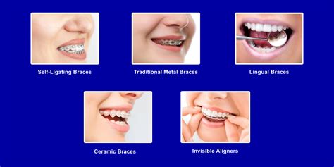 Types Of Braces And Costs Find The Best Option For Your Smile
